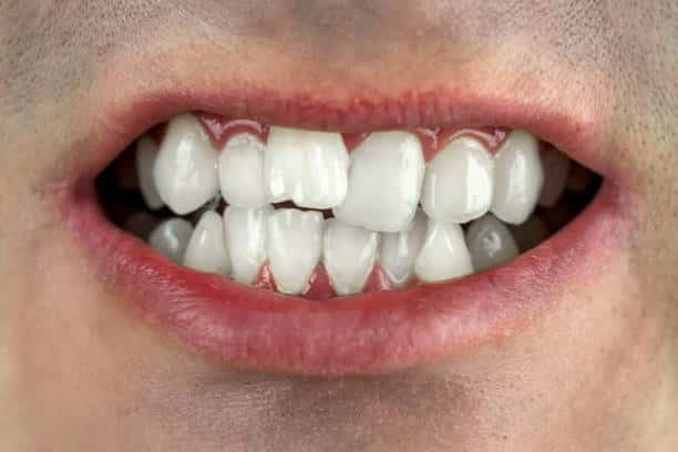 Will my teeth straighten out naturally? – Alexandra Hills Dental